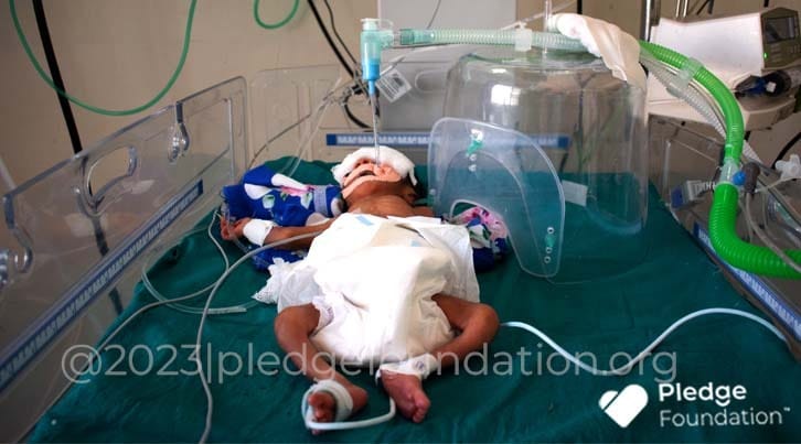 Baby of Swati is Born Premature and is suffering from Respiratory ...