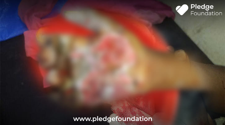 A Firecracker Shattered 10-Year-Old Kiran’s Hand | Needs Urgent Help